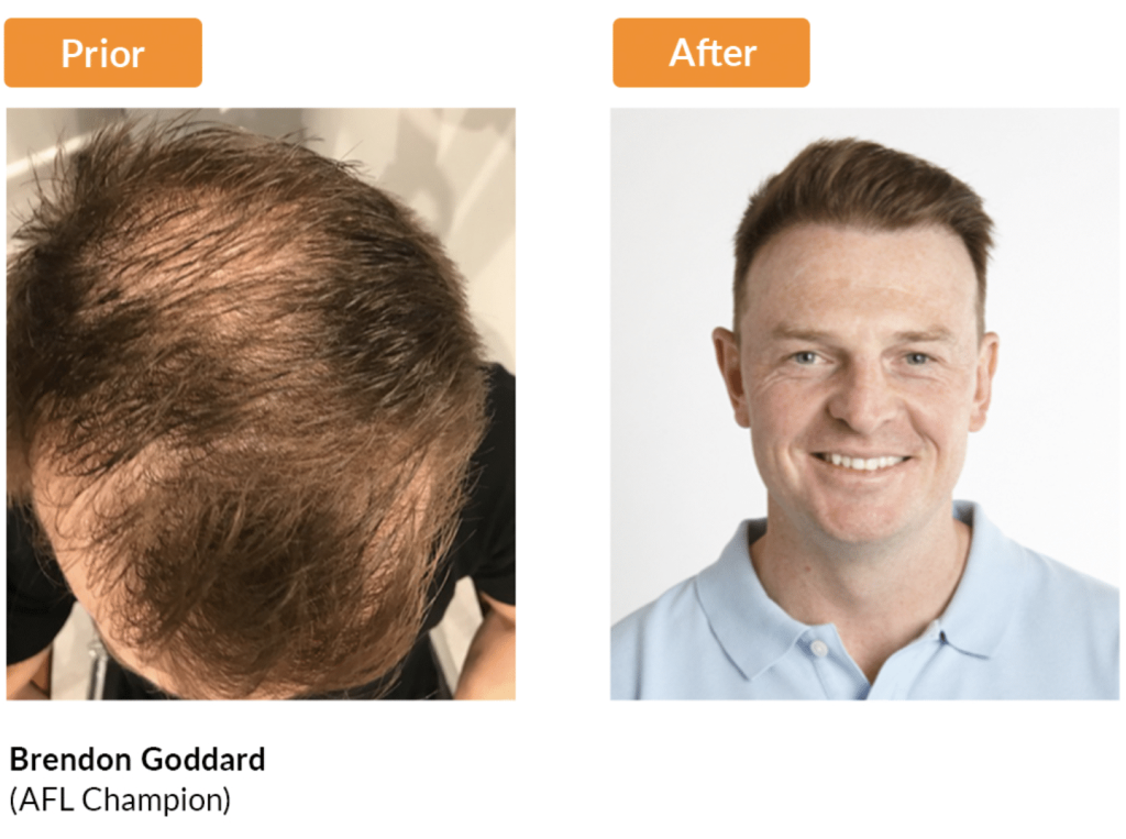 Strand-By-Strand® Hair Transplant - Advanced Hair Studio