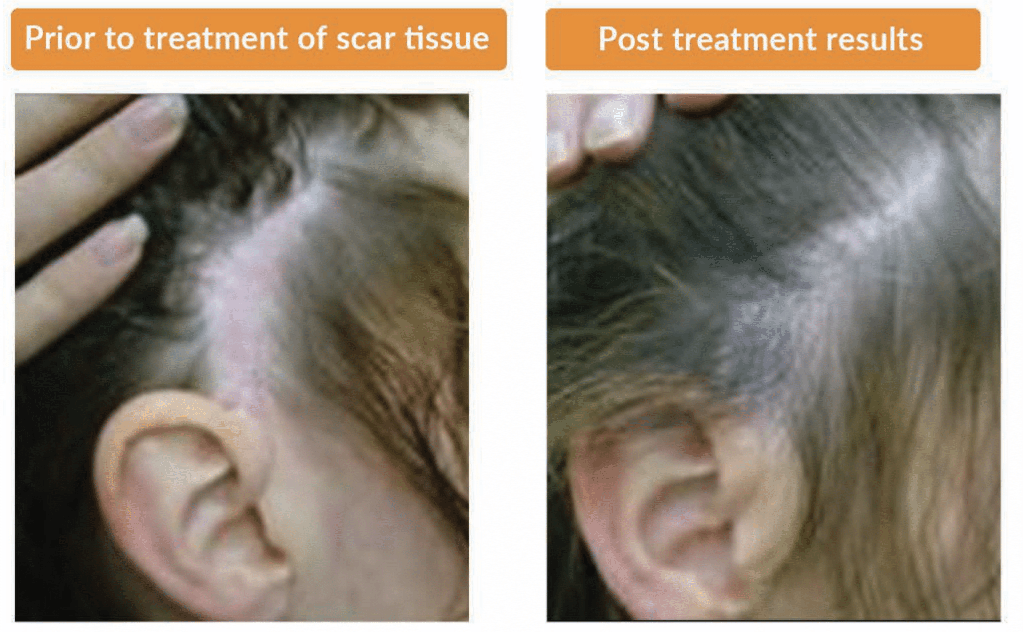 FUE Hair Transplants - Follicular Unit Extraction Procedure UK